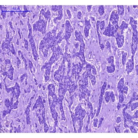 Year Old Man With Cholangiocarcinoma Bismuth Type Iv And Right Portal Download Scientific