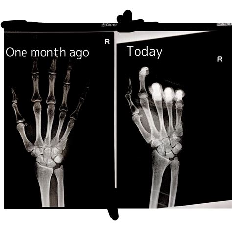 5th Metacarpal Broken R Brokenbones
