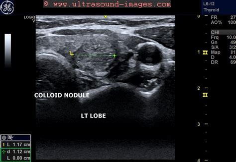 Thyroid Nodules