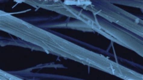 Differential Diagnosis Copd Exacerbation