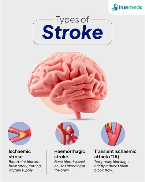 Stroke Causes Symptoms And Treatments Guide