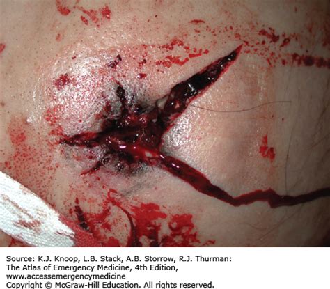 Gunshot Exit Wound