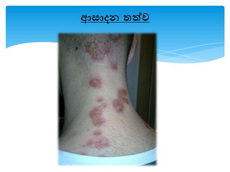 Physiotherapy ආසාධන තත්ව