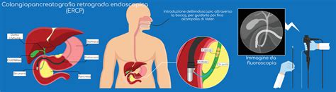 Colangiopancreatografia Retrograda Endoscopica Ercp Procedura E Complicazioni Scopri I
