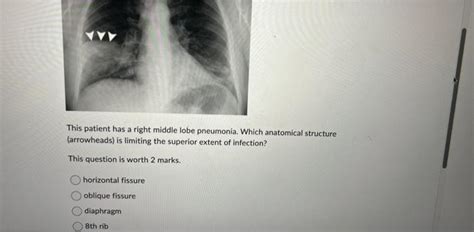 Solved This Patient Has A Right Middle Lobe Pneumonia Which
