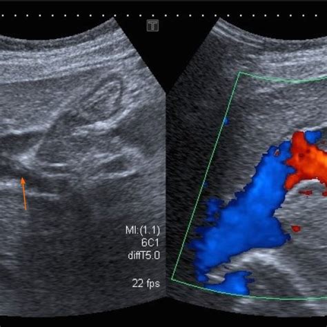 Abdominal Computed Tomography Image Of The Intrahepatic Portosystemic