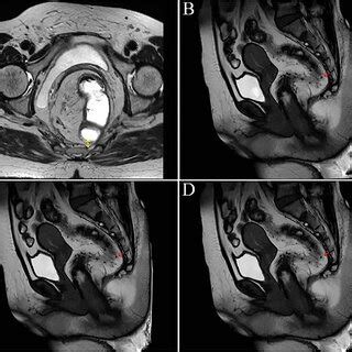 MRI Defecography Of The Rectum In The Control Group A Showed The Cross Download Scientific