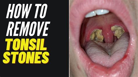 Tonsil Stones Uncomfortable At Janet Simmons Blog