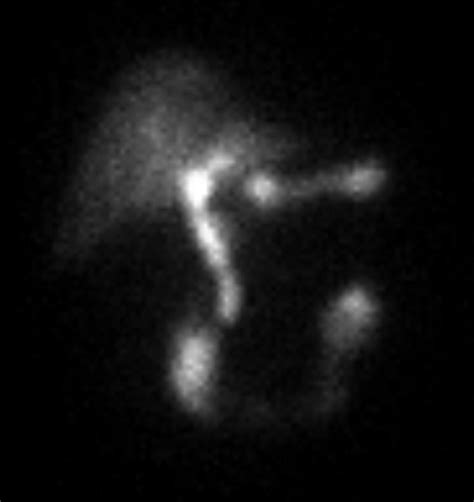 Abnormal Gallbladder Hida Scan Results