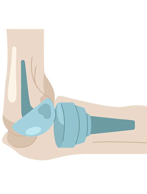 Arthrose Et Prothèse Du Coude à Aix En Provence Pacas