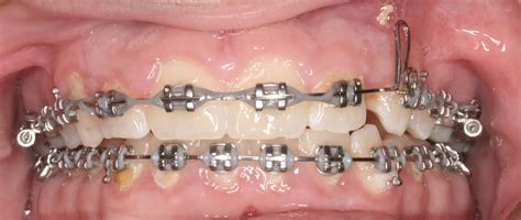 Orthodontic Scars And How To Avoid Them — Go Forth And Smile Orthodontics