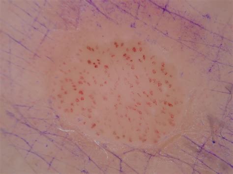 Comprehensive Skin Checks Dermoscopy Molesafe