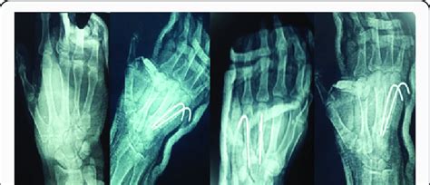 4 Th And 5 Th Metacarpal Fractures Managed By K Wire Fixation Download Scientific Diagram