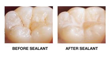 Composite Resin Bonding Teeth Bonding Dental Sealants Fl
