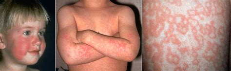 Erythema Infectiosum Lacy Rash