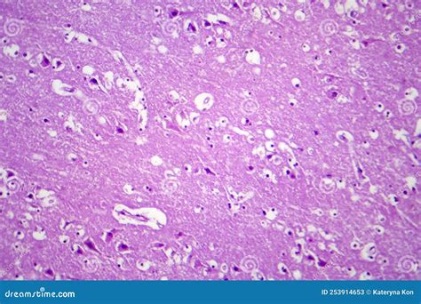 Histopathology Of Japanese Encephalitis Light Micrograph Stock Image