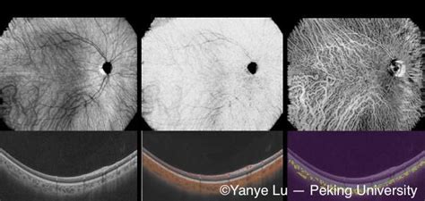 Noninvasive Choroidal Vessel Analysis Using Deep Learning A Novel Approach To Oct Angiography