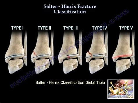 Salter Harris Fracture Classification Everything You Need To Know