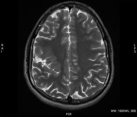 Right Perisylvian Syndrome Eurorad