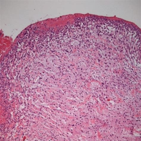 Intra Operative Image Of The Atrial Sarcoma Immediately After Resection Download Scientific