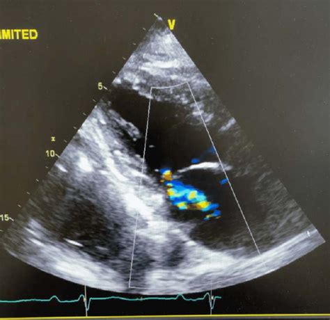 Echocardiogram In Parasternal Long Axis View With Colour Doppler Download Scientific Diagram
