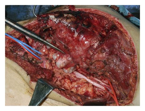 A Resection Line Of The Coracoid Process B Resection Line Of The