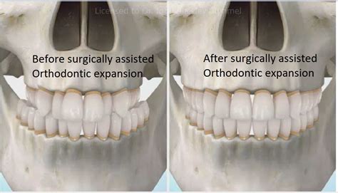 Palate Expander Before And After
