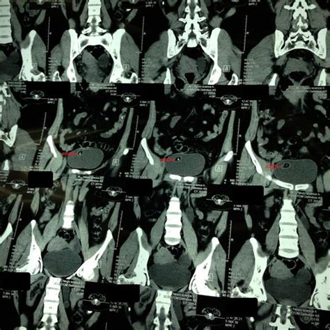 Check Cystoscopy Image Showing Hairy Grayish Bladder Mass Download