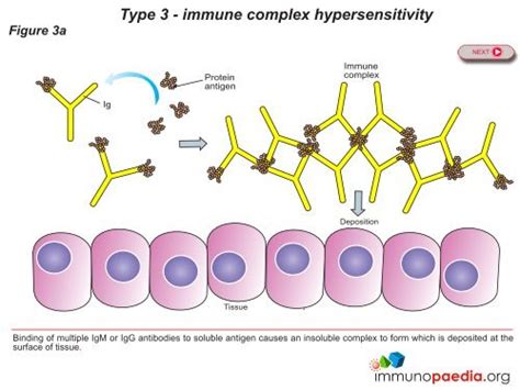 Type 3 Immune Complex Hypersensitivity Immunopaedia