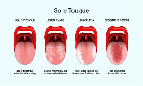 Why Do I Keep Getting Sores On My Tongue Infoupdate Org
