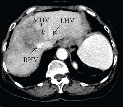 Patient 3 A B Colorectal Liver Metastasis With Right And Middle