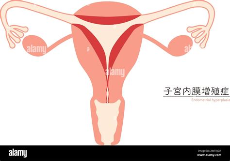Diagrammatic Illustration Of Endometrial Hyperplasia Anatomy Of The