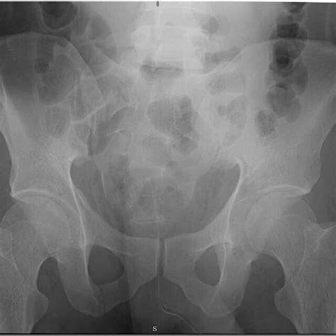 Anterior Posterior View Demonstrating Displaced Fracture Line In The Download Scientific