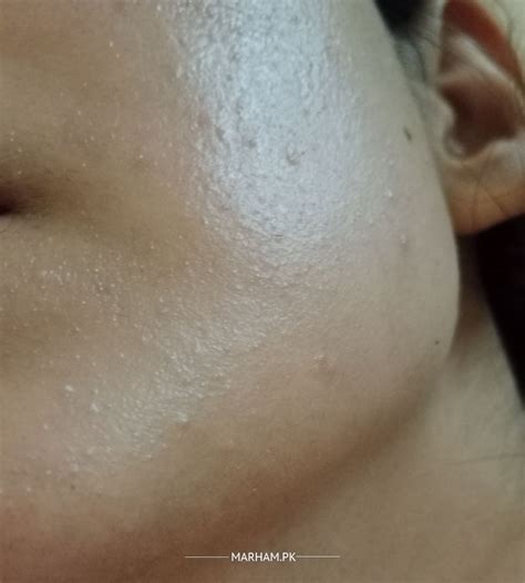 Ask A Dermatologist Online For Tiny Bumps On Face Inside Skin