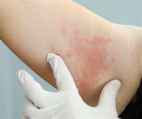 Skin Lesions Types Causes And Treatment Guide