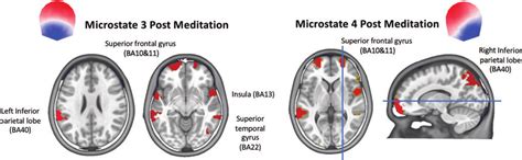 Source Localization Of Microstates 3 And 4 Derived By Averaging All