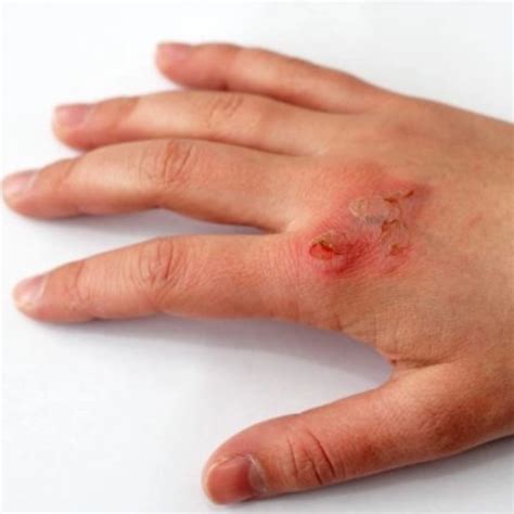 Indication Skin Ulcers Everlastwellness
