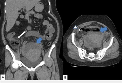Acute Appendicitis With Perforation A Coronal And B Axial Images