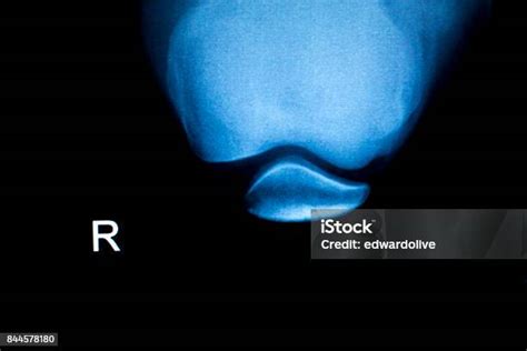 정형 외과 무릎 합동 초승달 모양 인 대 힘 줄과 연골 부상 부상 엑스레이 스캔 X 레이에 대한 스톡 사진 및 기타 이미지 X 레이 건강 진단 건강관리와 의술