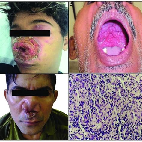 Clinical Aspects Of Anergic Diffuse Cutaneous Leishmaniasis Adcl