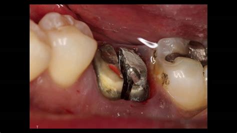 Lower Molar Extraction