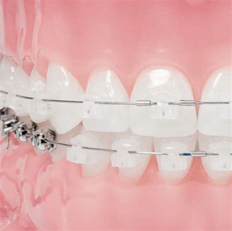 Brackets Estéticos Ortodoncia Brackets Ortodoncia Brackets