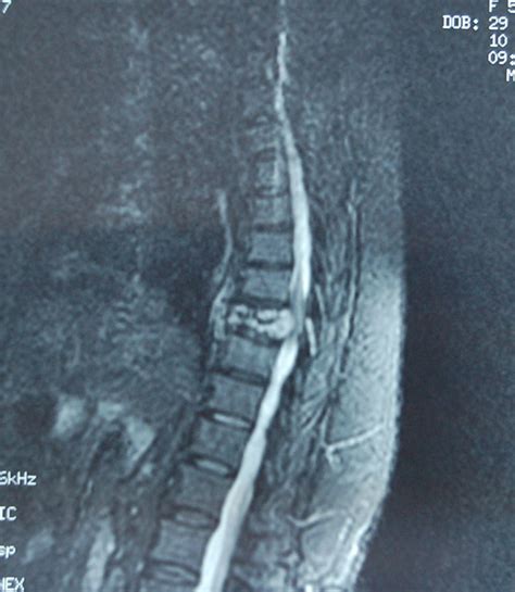 Angiosarcoma Epitelioide Vertebral Primario Revista Española De