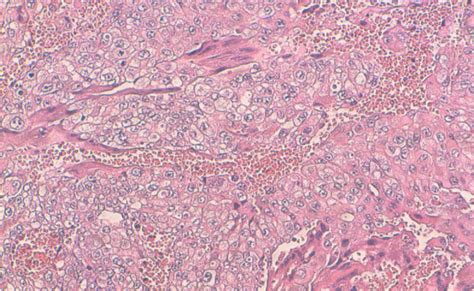 Syncytiotrophoblasts And Cytotrophoblasts Cells Along The Hemorrhagic