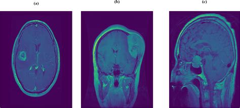 Enhancing Brain Tumor Mri Classification With An Ensemble Of Deep Learning Models And