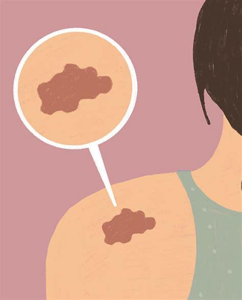 Spinocellular Carcinoma Hautärztin Duribe Holmgren