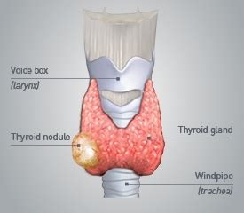 Thyroid Nodules Types Of Thyroid Nodules And Treatments