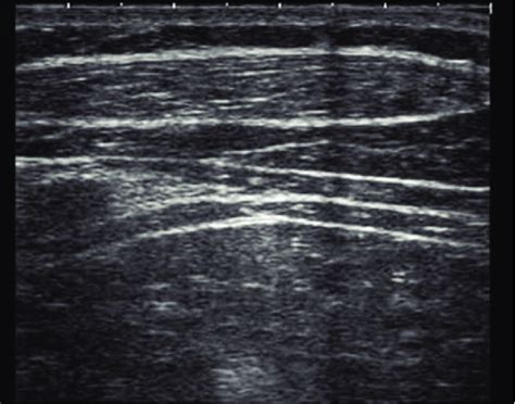 Ultrasound Image Of The Subcutaneous Lipoma The Image Shows Normal