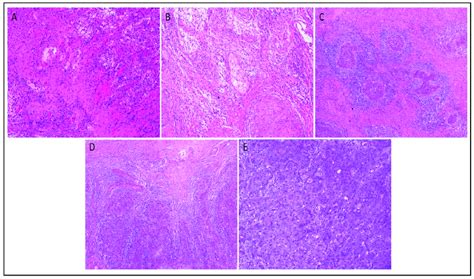 Tumor Regression Grading Trg After Preoperative Chemo Radiotherapy In