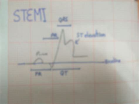 Solution Normal Ecg Stemi Ischemia Pericarditis Basic Difference